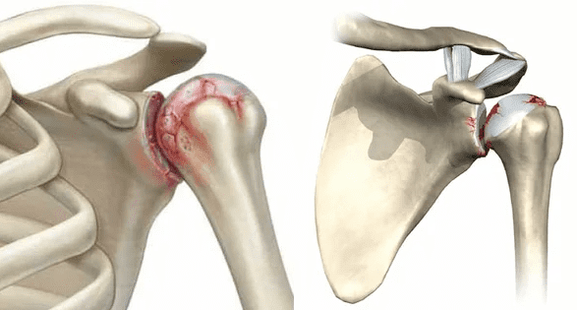 Artrosi della spalla: sintomi, cause, diagnosi e trattamento - Hondrogel Artrosi della spalla: sintomi, cause, diagnosi e trattamento - Hondrogel